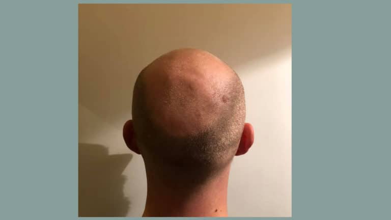 Zijn kale mannen aantrekkelijk? - All Kinds of Things